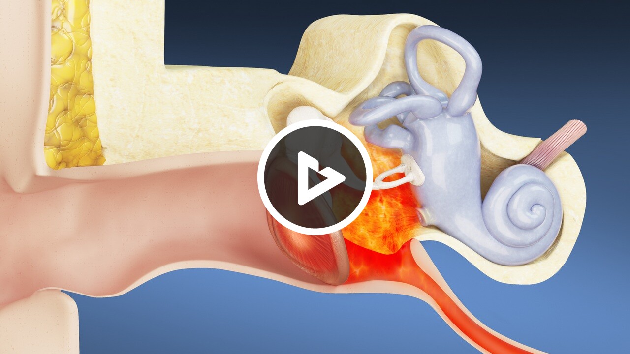 Chronic Ear Infections in Children - ENT Services - Willis Knighton Ear ...